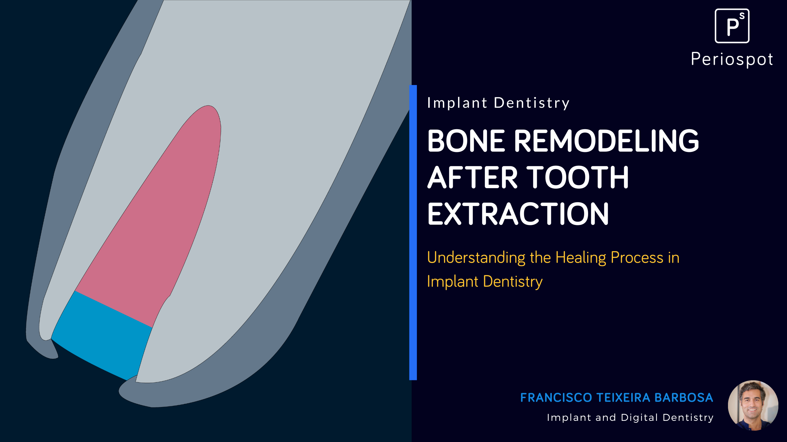 Bone Remodeling After Tooth Extraction: Healing Process & Timeline ...